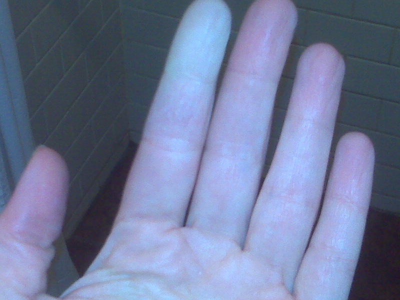 Raynaud's Sydrome (plus gross hand pics, plus I might be a vampire ...